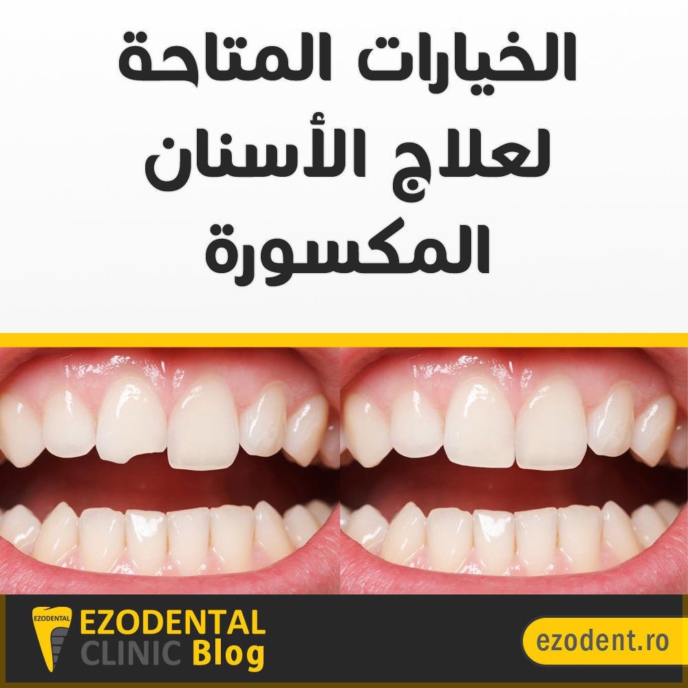 Options for Treating Broken Teeth – EZO DENTAL CLINIC