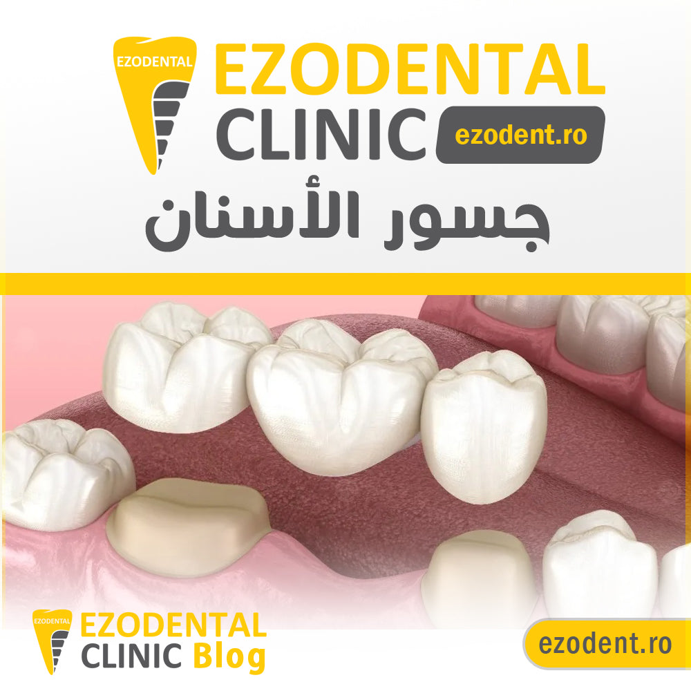 Podurile dentare – EZO DENTAL CLINIC